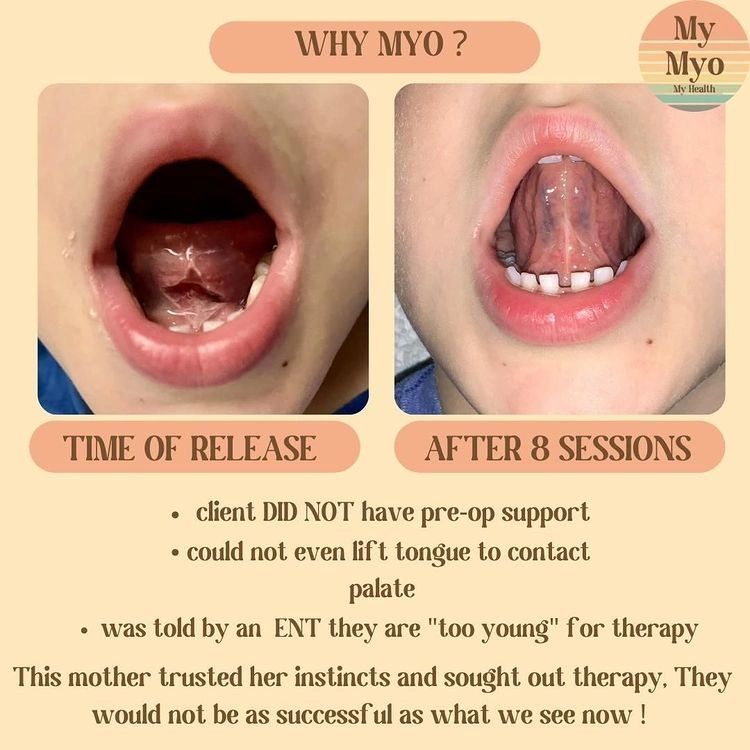 PSA: We need to see you BEFORE a tongue-tie procedure